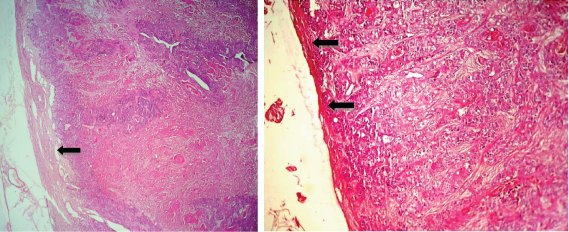 A 40X magnification showing myxoid tissue showing star shape cells ...