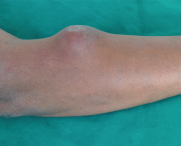 Single, soft fluctuant swelling on extensor aspect of Rt. forearm ...